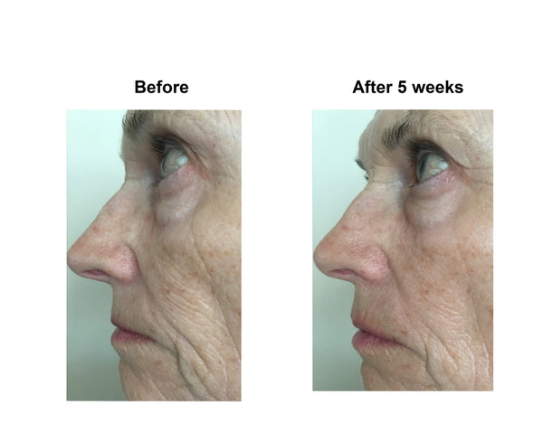 Fluorouracil Before And After Pictures